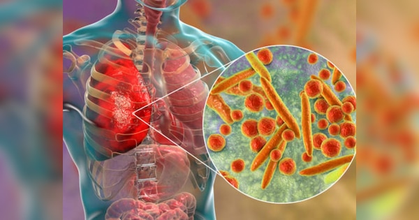 Mycoplasma Pneumoniae symptoms precautionsa and treatment nimoniya se ...