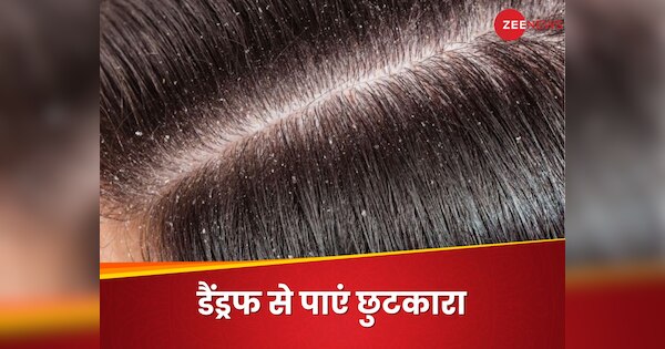 Home remedies to get rid of dandruff in winter |Home remedies to get ...