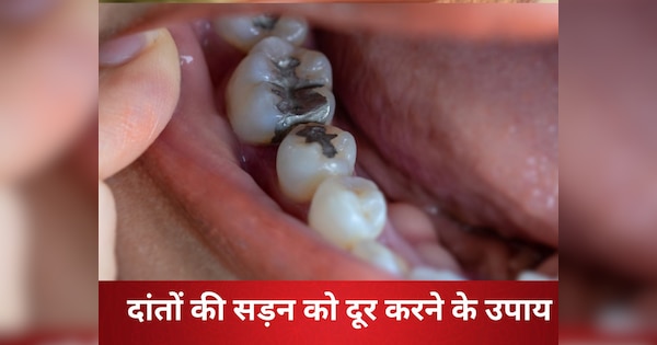 How to remove tooth decay with home remedies | दांतों की सड़न को दूर ...