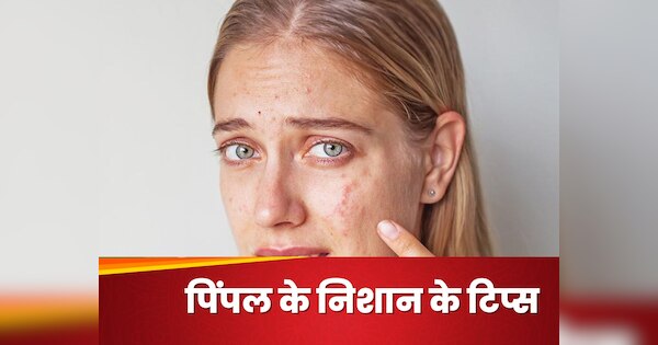 How To Cure Pimple Marks On Face With Home Remedies Pimple Marks