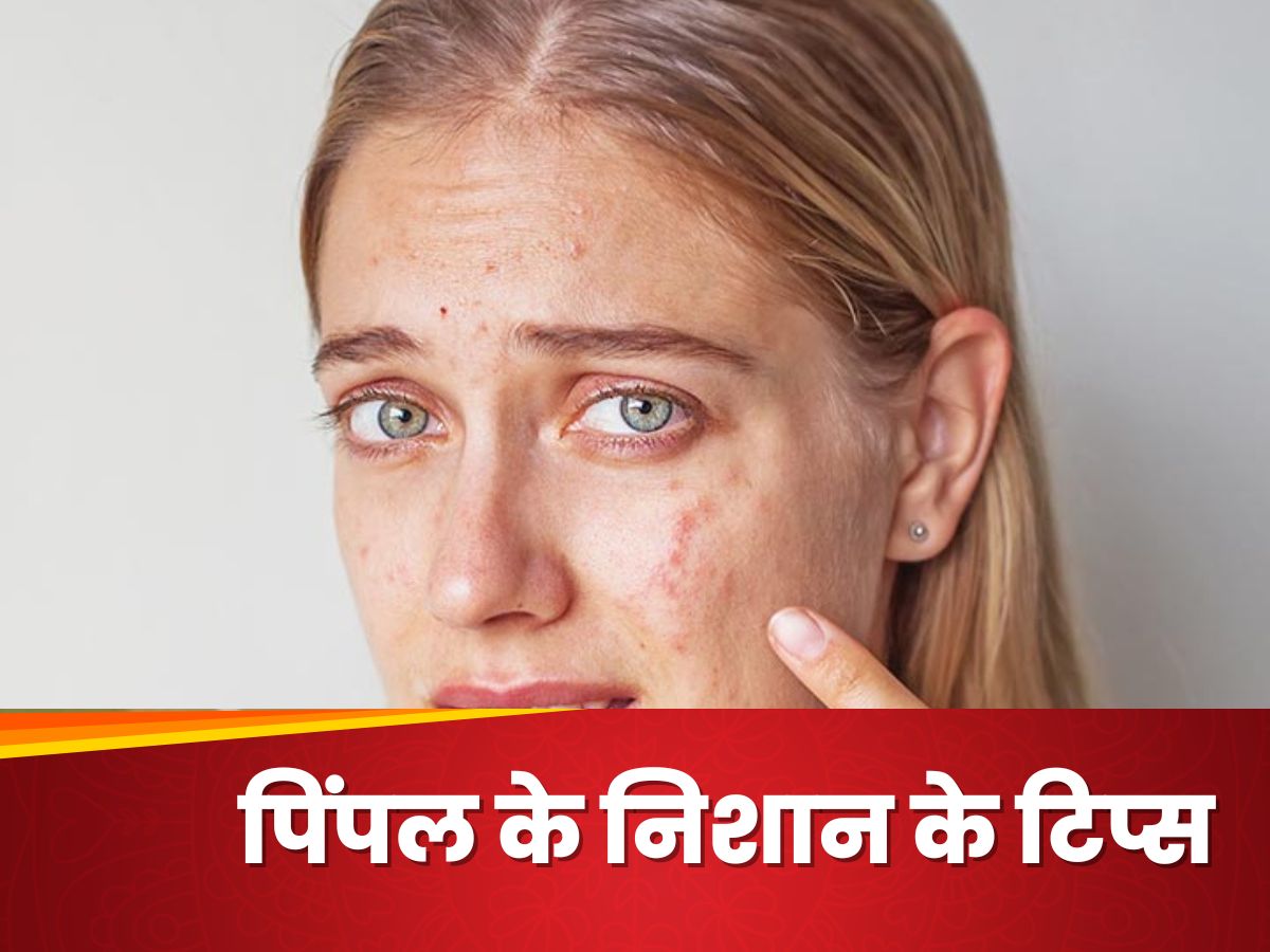 How To Cure Pimple Marks On Face With Home Remedies Pimple Marks