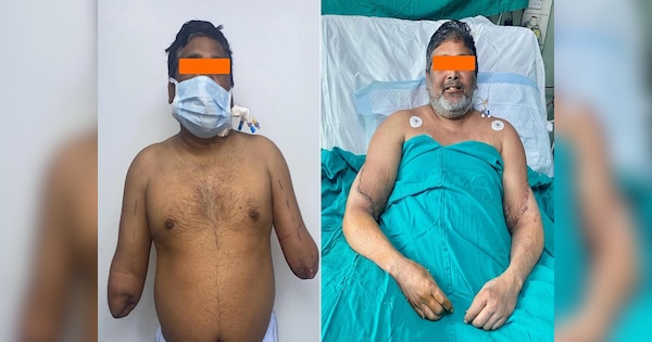Delhis first successful bilateral hand transplant at Ganga Ram Hospital ...