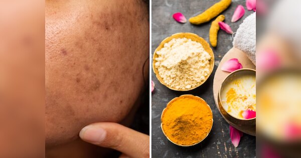 How to get rid of Pigmentation disorder naturally home remedies for ...