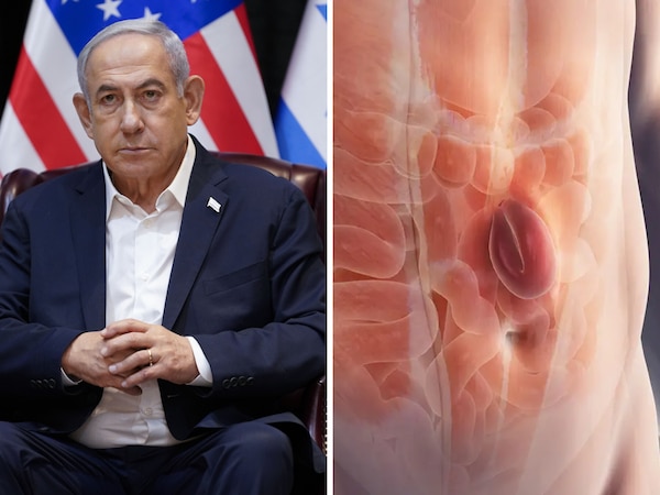 hernia surgery, Israel PM Benjamin Netanyahu Undergoes Hernia Surgery ...