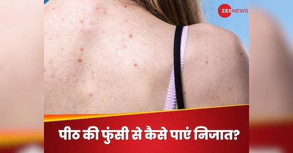 Back Acne Home Remedies Peeth Ki Funsi Daane Kaise Karen Door | Back Acne: पीठ की फुंसी के कारण ...