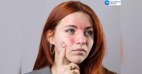 If Such Rashes Are Visible On The Body Then Be Careful You May Be A 0885