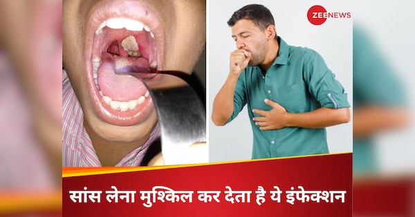 symptoms of Diphtheria infection caused 5 deaths in odisha prevention ...