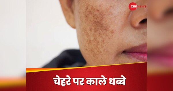 These 4 Bad Habits May Cause Dark Spots on Your Face Skin Care Issues ...