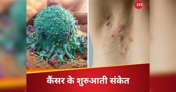 early symptoms of growing Cancer in the body do not ignore minor signs ...