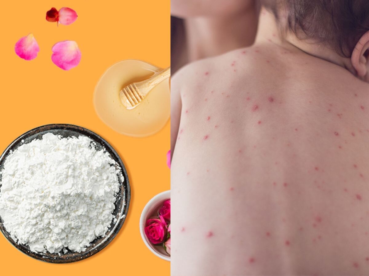 Skin rashes in Babies Essential Monsoon Baby Care Tips During Monsoon ...