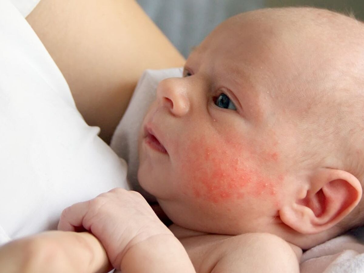 Skin rashes in Babies Essential Monsoon Baby Care Tips During Monsoon ...