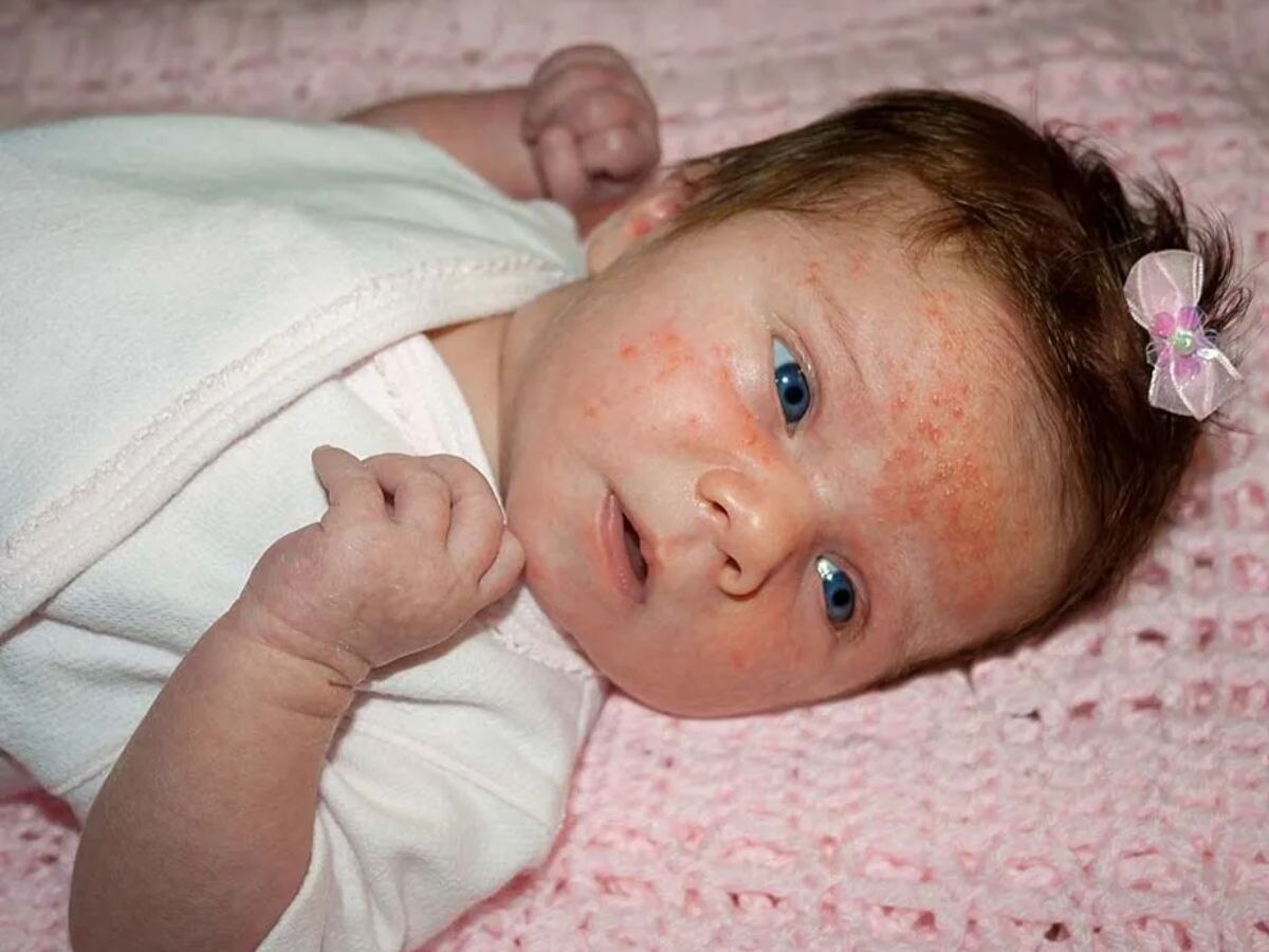 Skin rashes in Babies Essential Monsoon Baby Care Tips During Monsoon ...