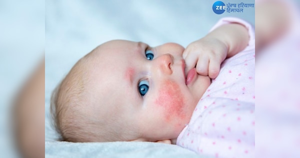 Skin rashes in Babies Essential Monsoon Baby Care Tips During Monsoon ...