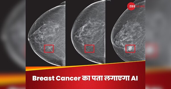AI Can Detect Breast Cancer 5 years before it develops throuh Mirai ...