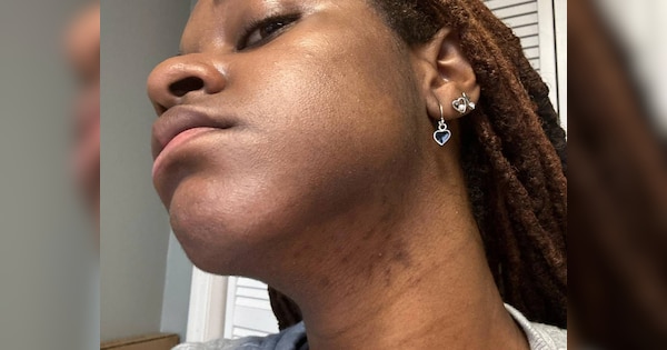 Remove pigmentation on neck with home remedies