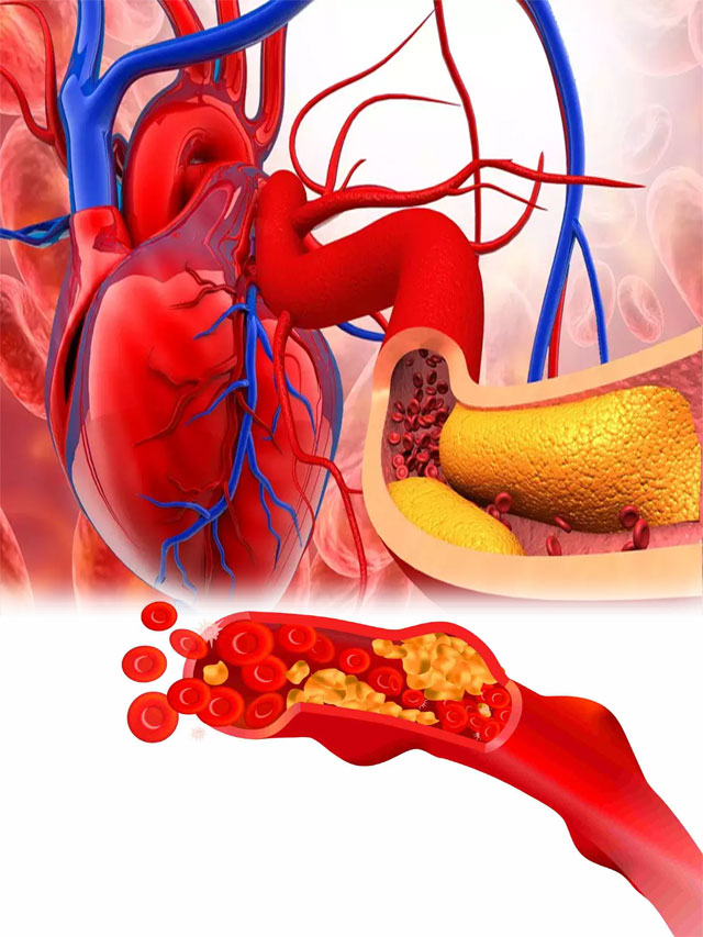 Cholesterol: कोई नहीं बताएगा क्यों बढ़ता है कोलेस्ट्रॉल, समय रहते करें ...