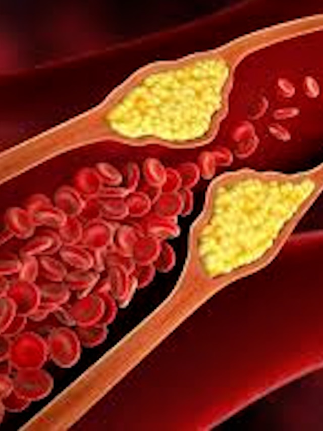 high cholesterol causes pain in these body parts