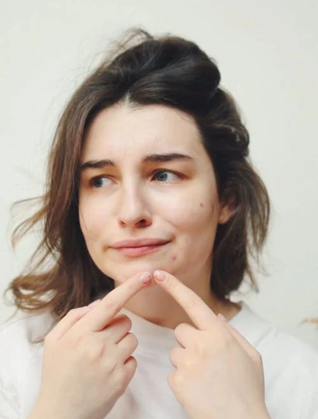 Pimple Removing Tips: पिंपल्स को एक दिन में कहें अलविदा, अपनाएं ये 5 ...