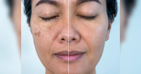 Freckles on your face will clean up before Diwali try these remedies to ...