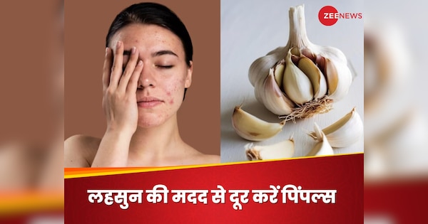 How a Clove of Garlic Can Solve Pimples Acne Glow Dark Spots Skin Pores ...