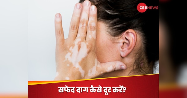 Skin se safed daag mitane ke ayurvedic upay Ayurvedic remedy to remove ...
