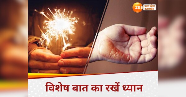 How to do patient first aid in skin burns wounds due to fire crackers ...