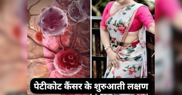 petticoat cancer | what is petticoat cancer | what are symptoms of ...