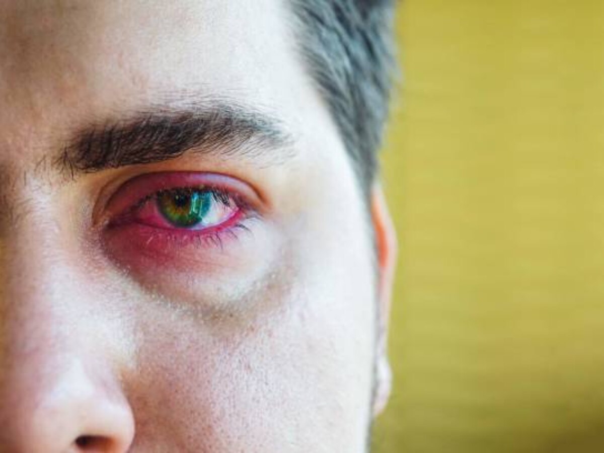 How do I cure my eye infection| What is the most common type of eye ...