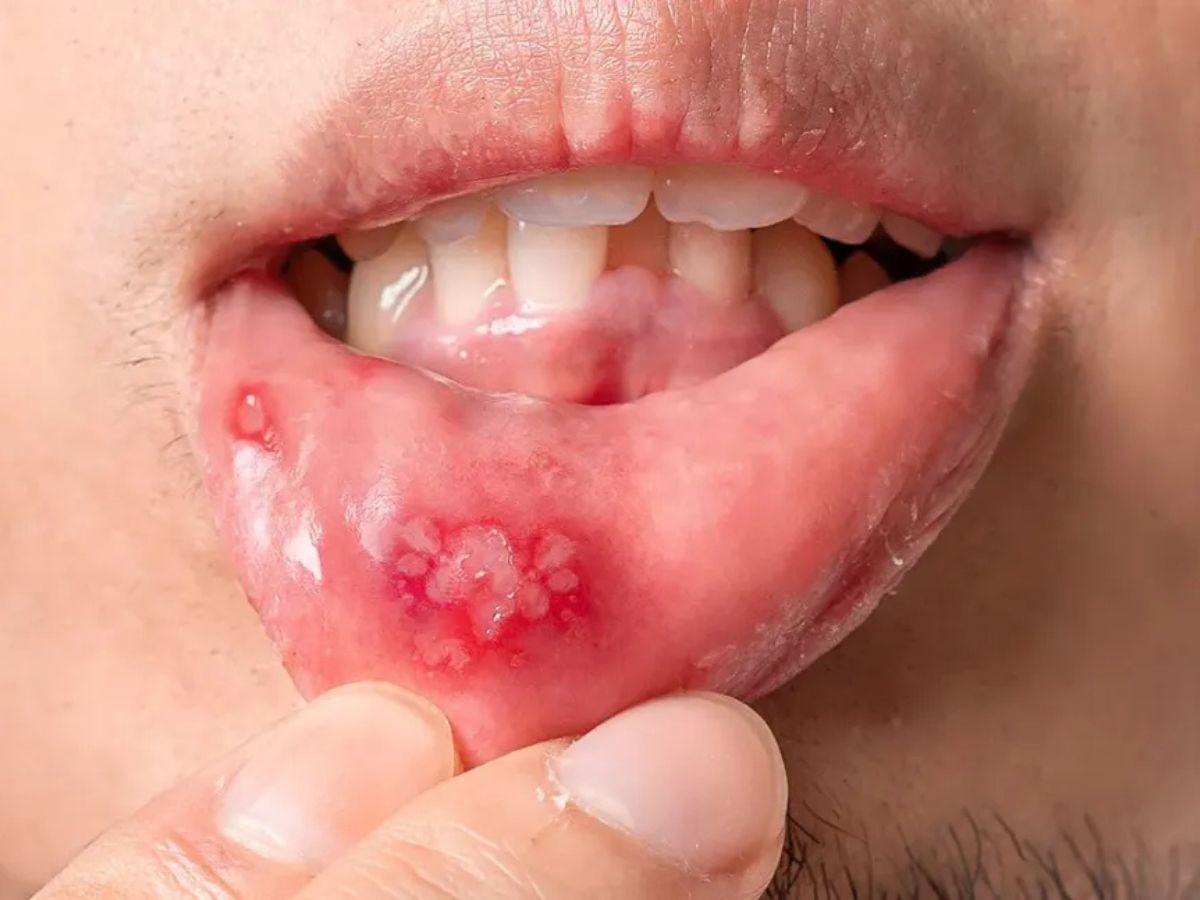 Mouth cancer: jaw pain to chronic sores 5 warning signs to watch out ...