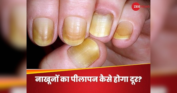 Dirty Yellow Nails Cleaning Hacks Peele Nakhun Kaise Saaf Karen Lemon ...