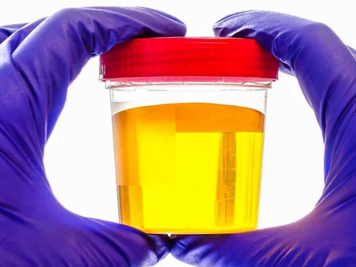 Urine Colours With Meaning Light Dark Yellow Green Brown Cloudy Red ...