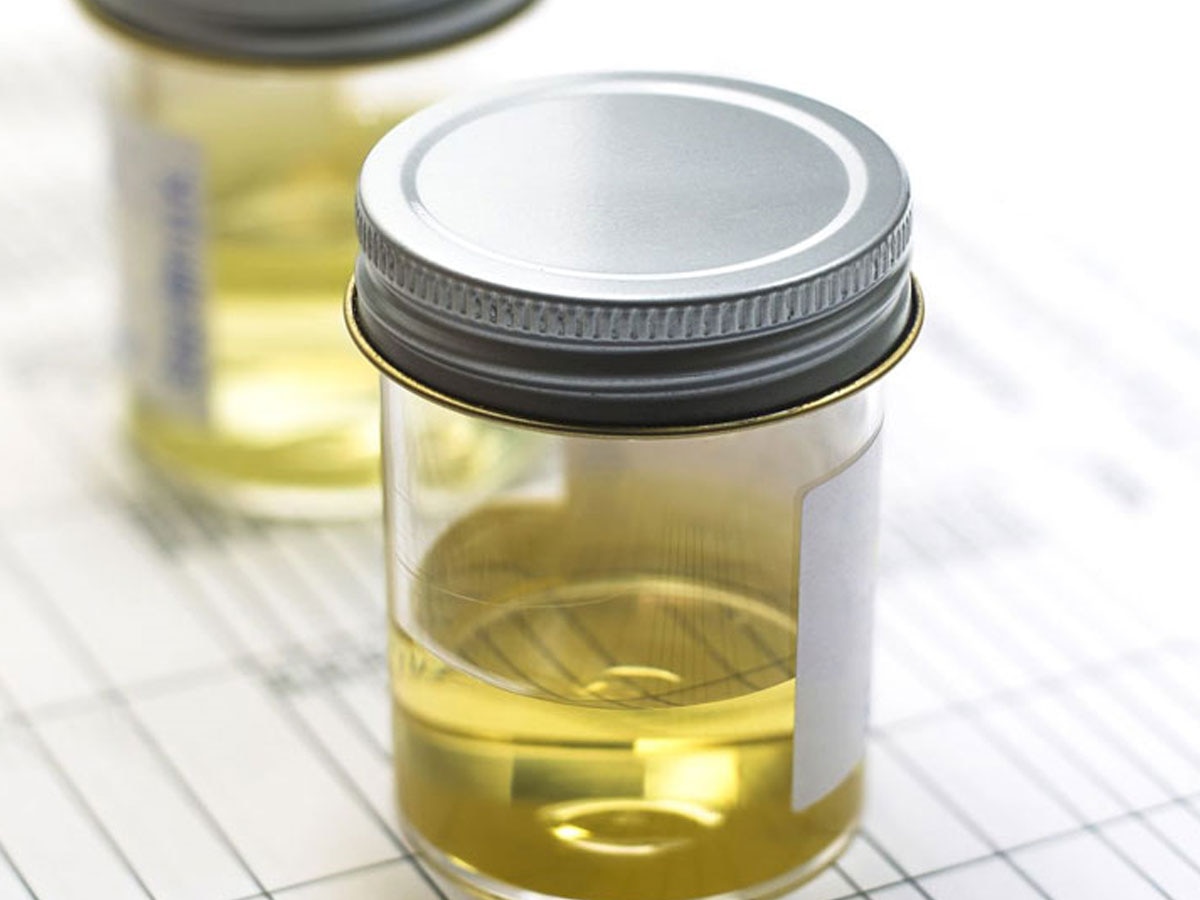 Urine Colours With Meaning Light Dark Yellow Green Brown Cloudy Red ...
