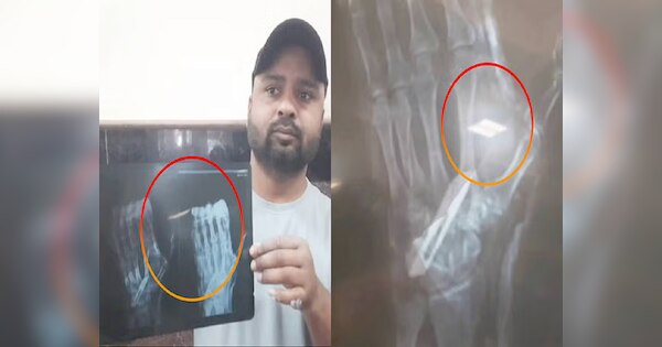 kota mbs hospital Blade left inside due to nursing staff negligence | Kota News: एमबीएस अस्पताल ...