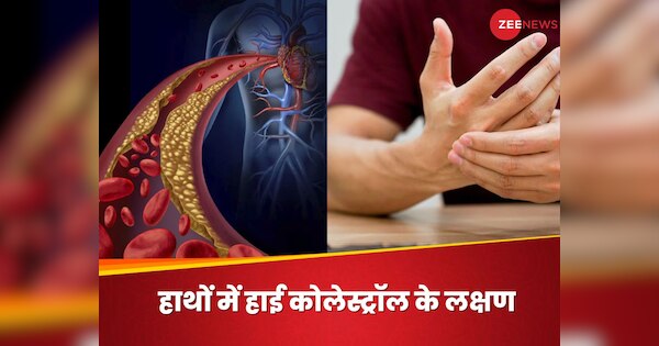 High Cholesterol Symptoms In Hands Warning Signs Pain tingling Yellow ...