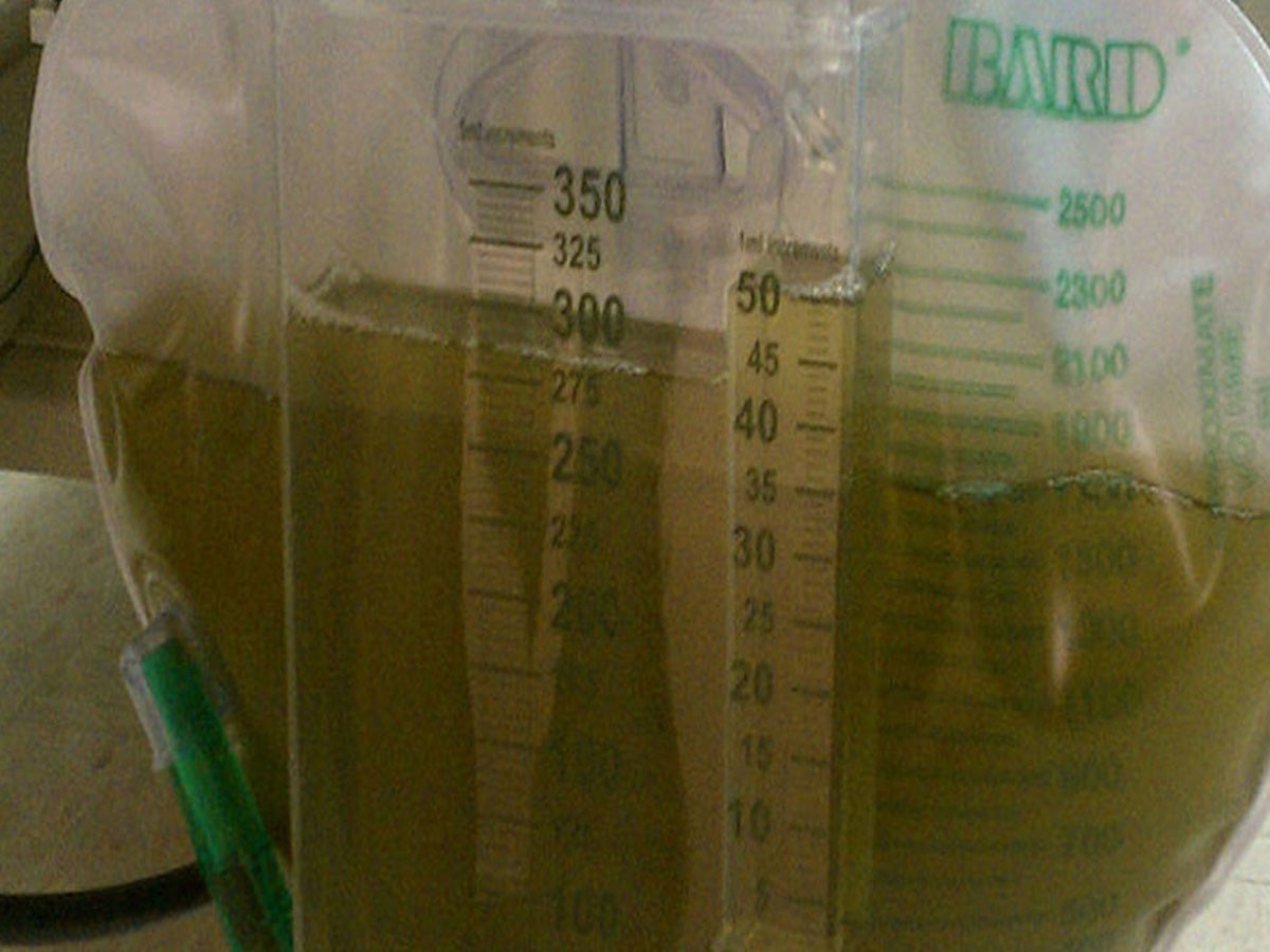 What Urine Colours Says Its Meaning peshab ke rang se jane bimari Ka ...