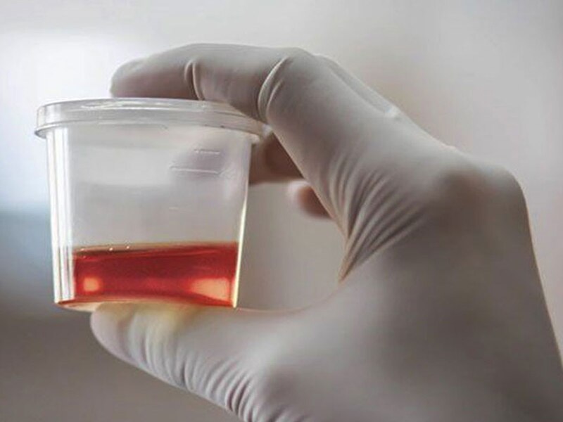 What Urine Colours Says Its Meaning peshab ke rang se jane bimari Ka ...