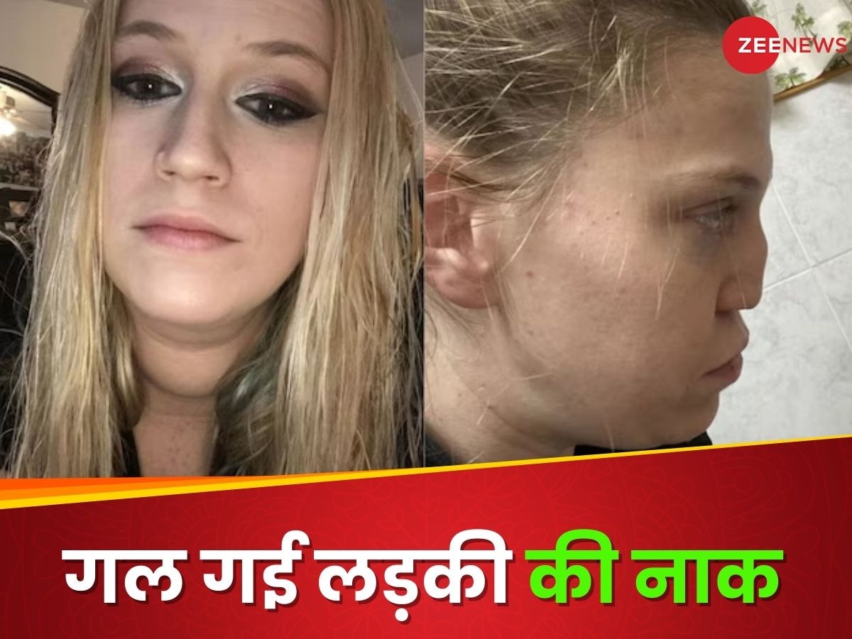 Viral News : नशे के चक्कर में गल गई नाक, ड्रग्स की लगी ऐसी लत कि बिगड़ ...