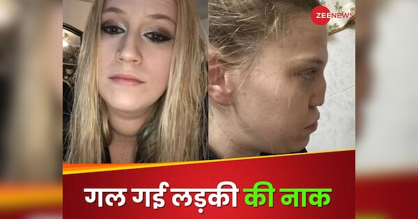 Viral News : नशे के चक्कर में गल गई नाक, ड्रग्स की लगी ऐसी लत कि बिगड़ ...