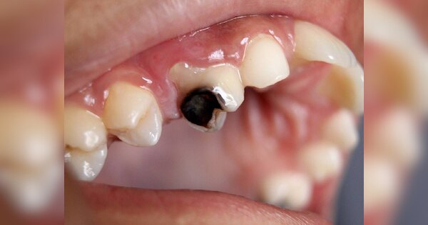 4 home remedies to remove tooth worms know how to get rid of cavity ...