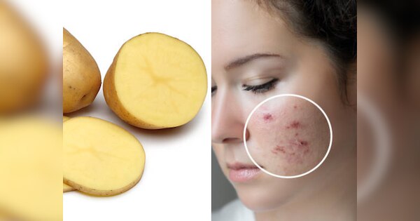 use potatoes like this pimples will disappear along with marks | चेहरे ...