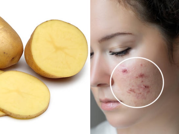 use potatoes like this pimples will disappear along with marks | चेहरे ...