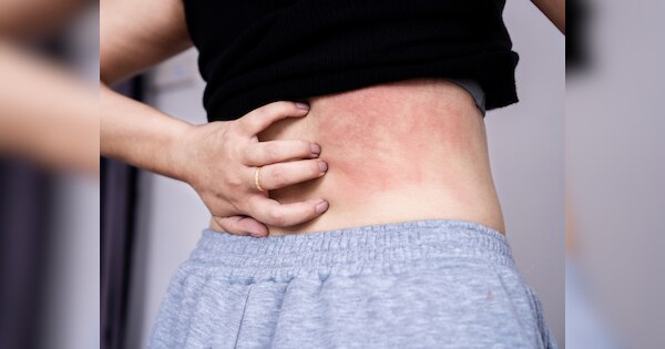 Heat rashes in summer what makes it worse and how to prevent them avoid ...