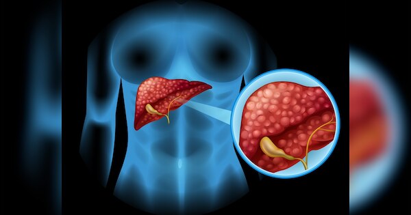 World liver day fatty liver is emerging as a new epidemic among youth ...