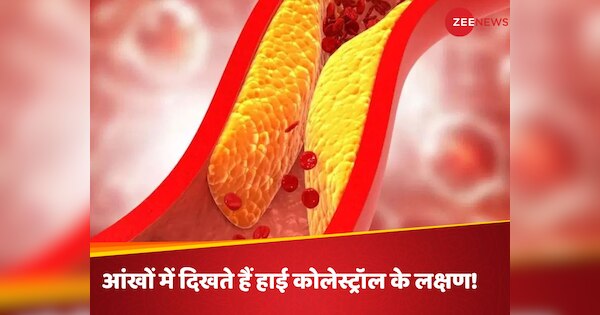 high cholesterol ldl symptoms signs can visible in your eyes | आंखों ...