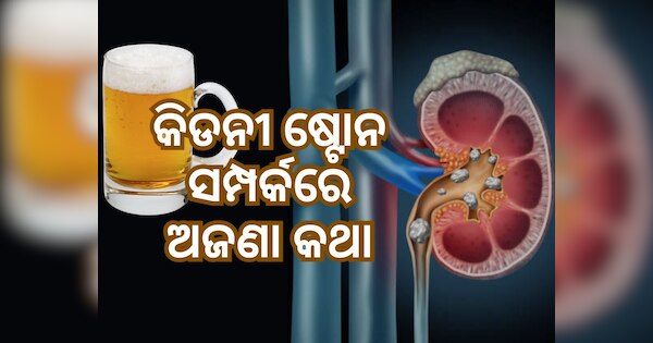 Does drinking beer cure kidney stones know experts opinion