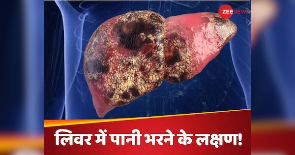 What causes water in liver | लिवर में पानी भरने के लक्षण | water in ...