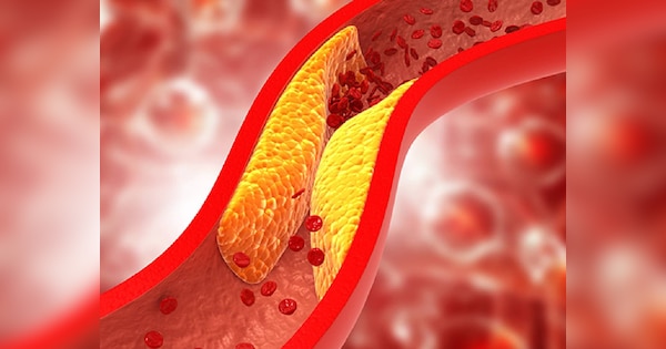नसों में बैड कोलेस्ट्रॉल कम कैसे करें | How to remove bad cholesterol ...
