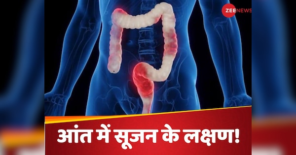 बड़ी आंत में सूजन के लक्षण | badi aant me sujan ke lakshan | आंत में ...