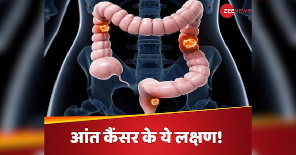 आंत में कैंसर के लक्षण | Colon cancer signs | आंत का कैंसर का लक्षण ...