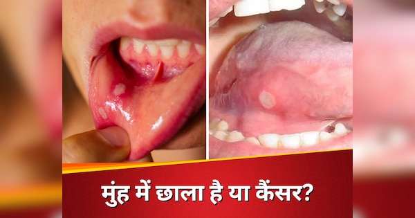 How to know which mouth sore is sign of cancer symptoms of mouth cancer ...